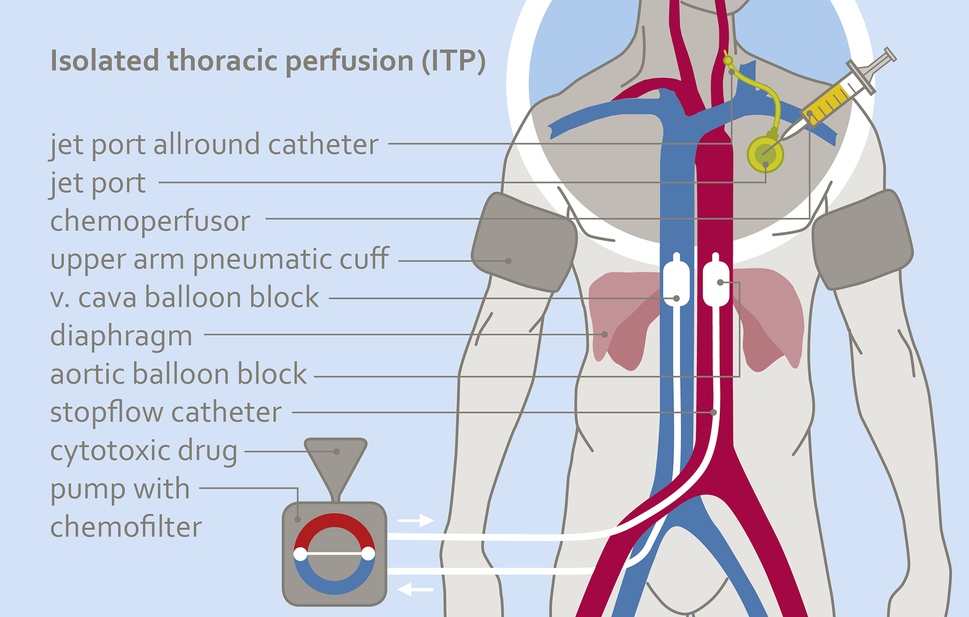 Short-term intra-arterial infusion chemotherapy for head and neck ...