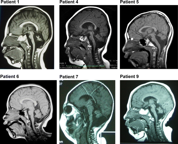 Novel intragenic duplications and mutations of CASK in patients with ...