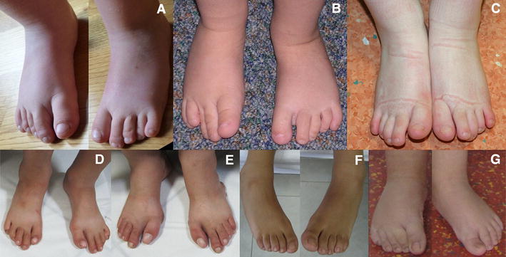 Clinical and mutation data in 12 patients with the clinical diagnosis ...