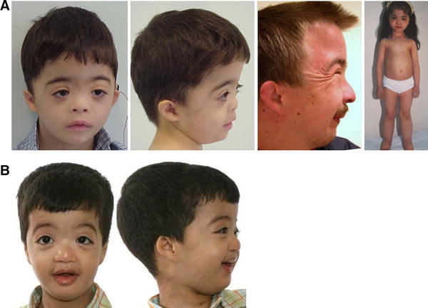 Hennekam syndrome can be caused by FAT4 mutations and be allelic to Van ...