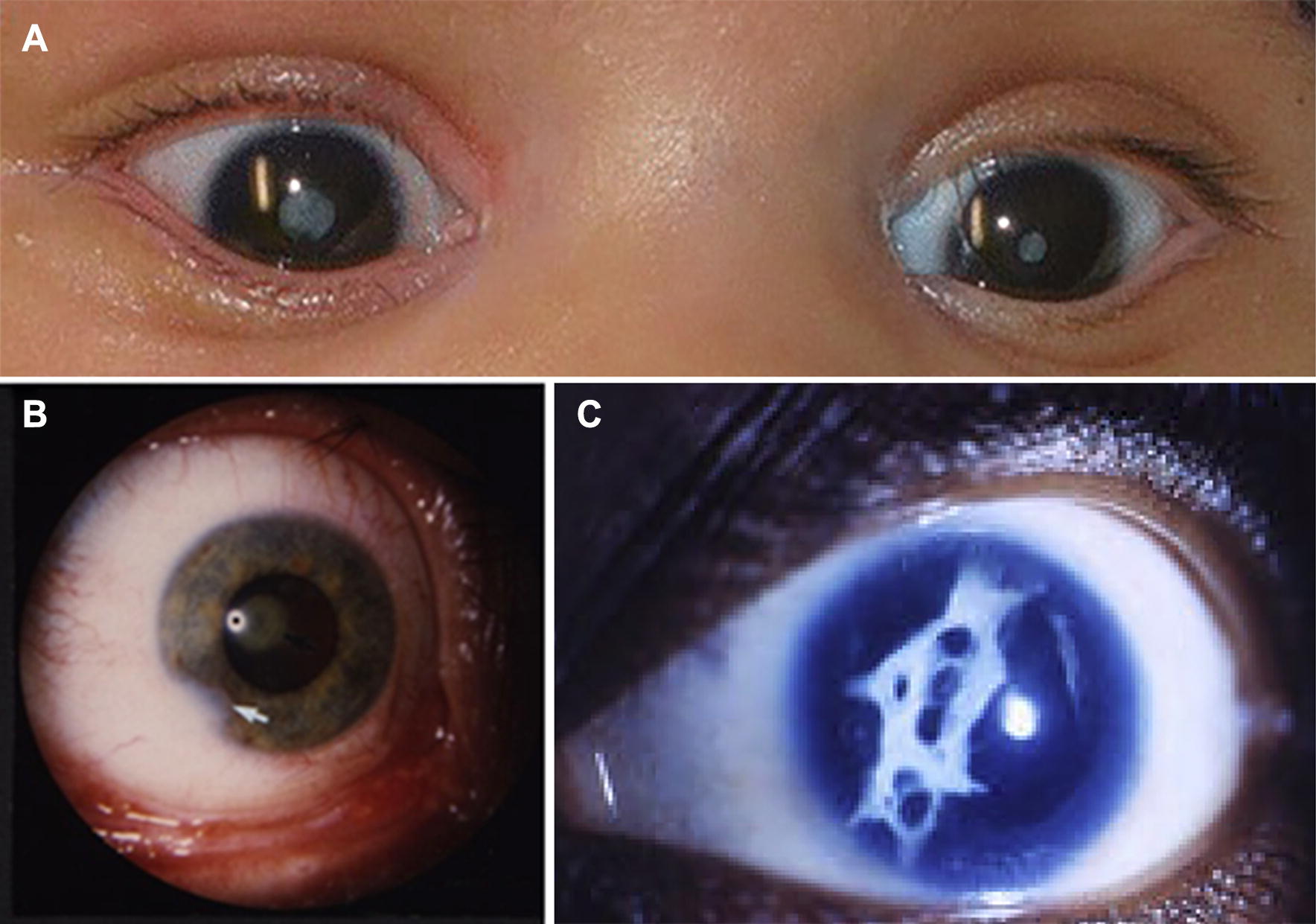 Genetic landscape of isolated pediatric cataracts: extreme ...