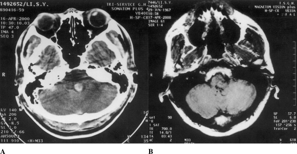 Prolonged Effect of Botulinum Toxin Injection in the Treatment of ...