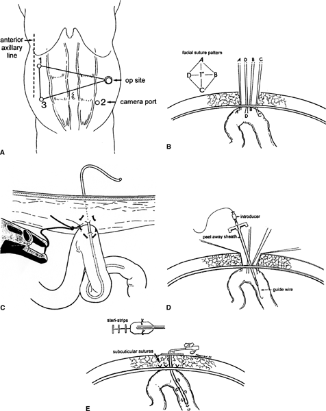 Laparoscopic feeding jejunostomy: A systematic review | SpringerLink