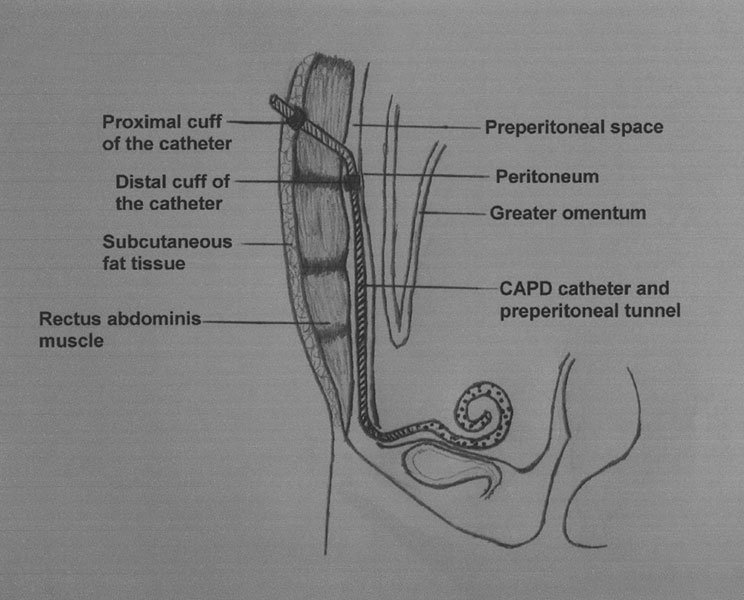 A new laparoscopic technique for the placement of a permanent ...