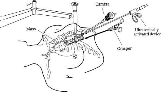 Alternative choices of total and partial thymectomy in video-assisted ...