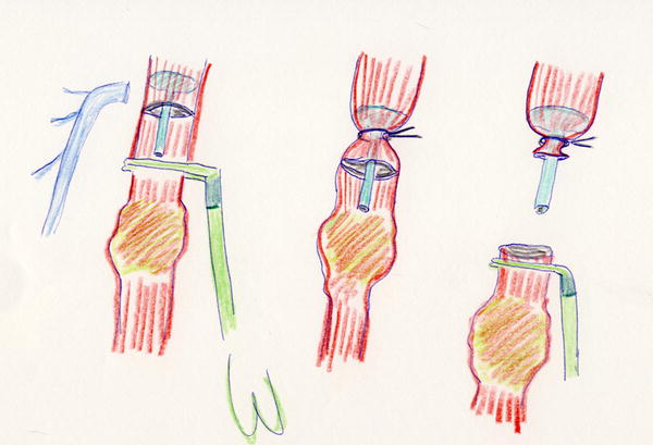 Minimally invasive intrathoracic anastomosis after Ivor Lewis ...