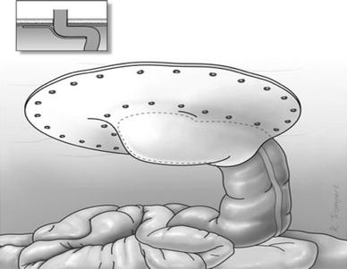 The laparoscopic modified Sugarbaker technique is safe and has a low ...