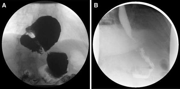 Combining laparoscopic giant paraesophageal hernia repair with sleeve ...