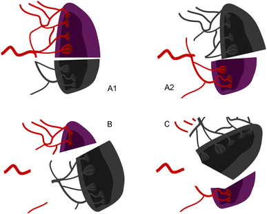 Partial splenectomy in the era of minimally invasive surgery: the ...