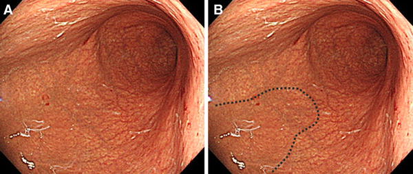 Endoscopic gastric atrophy is strongly associated with gastric cancer ...