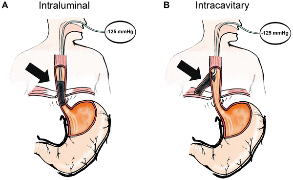 Successful closure of defects in the upper gastrointestinal tract by ...