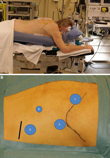 Minimally invasive esophagectomy: a propensity score-matched analysis of semiprone versus prone ...