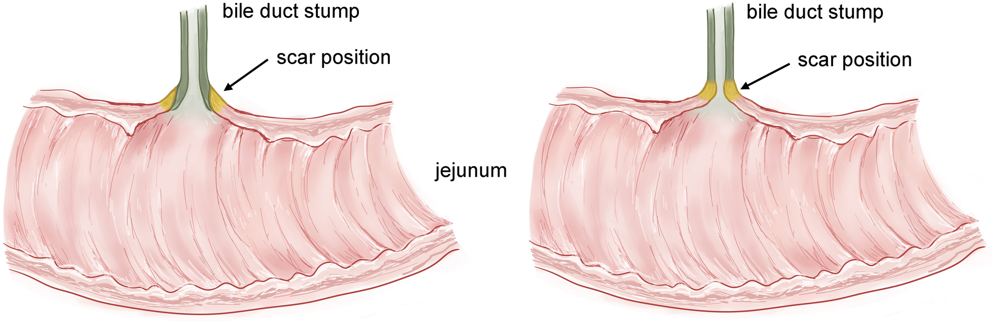 Laparoscopic-assisted cyst excision and ductoplasty plus widened ...