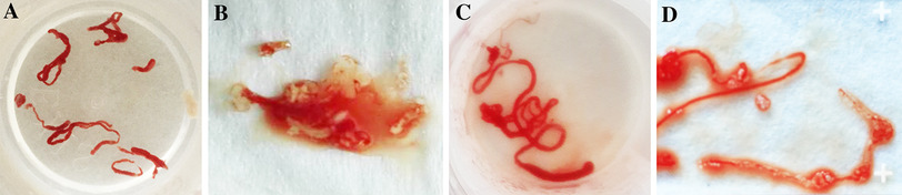Evaluation of 22G fine-needle aspiration (FNA) versus fine-needle ...