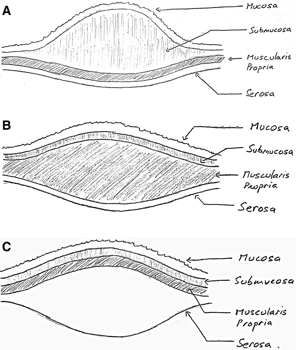 Sclerotherapy needle injections can expand the subserosal and ...