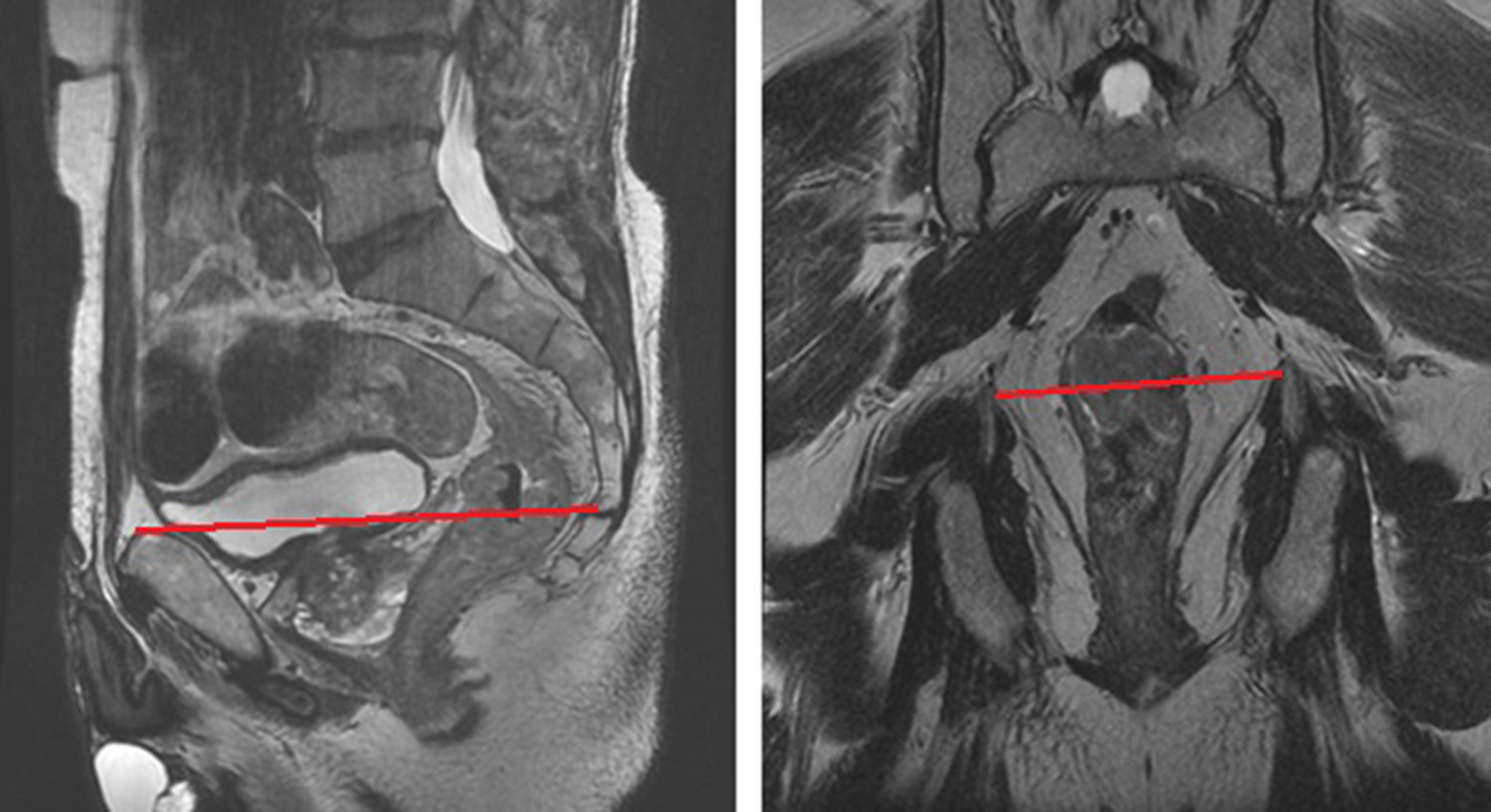 Transanal total mesorectal excision (TaTME) versus laparoscopic TME for MRI-defined low rectal ...
