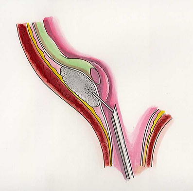 Vesicoureteral reflux: surgical and endoscopic treatment | SpringerLink