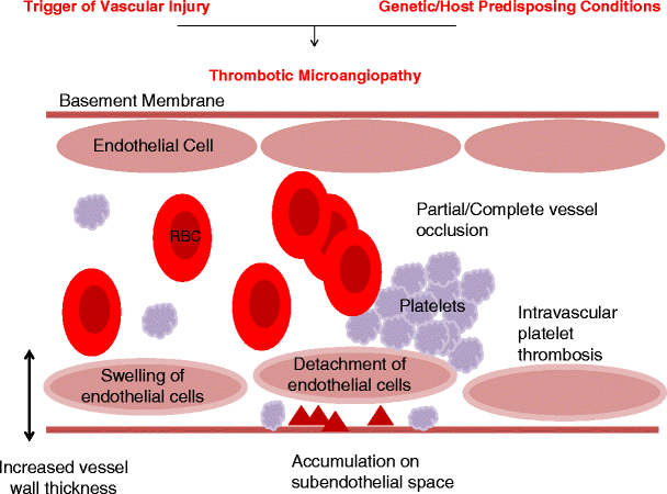 Advances in our understanding of the pathogenesis of glomerular ...