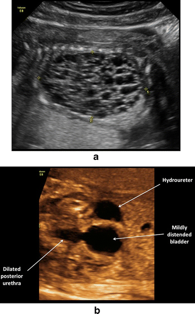 Defining and predicting ‘intrauterine fetal renal failure’ in ...