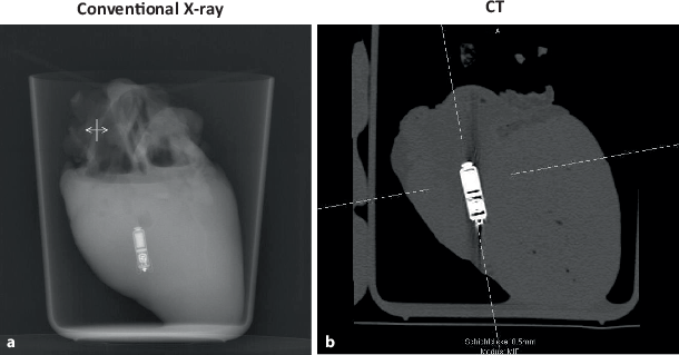 Visualization and appearance of artifacts of leadless pacemaker systems ...
