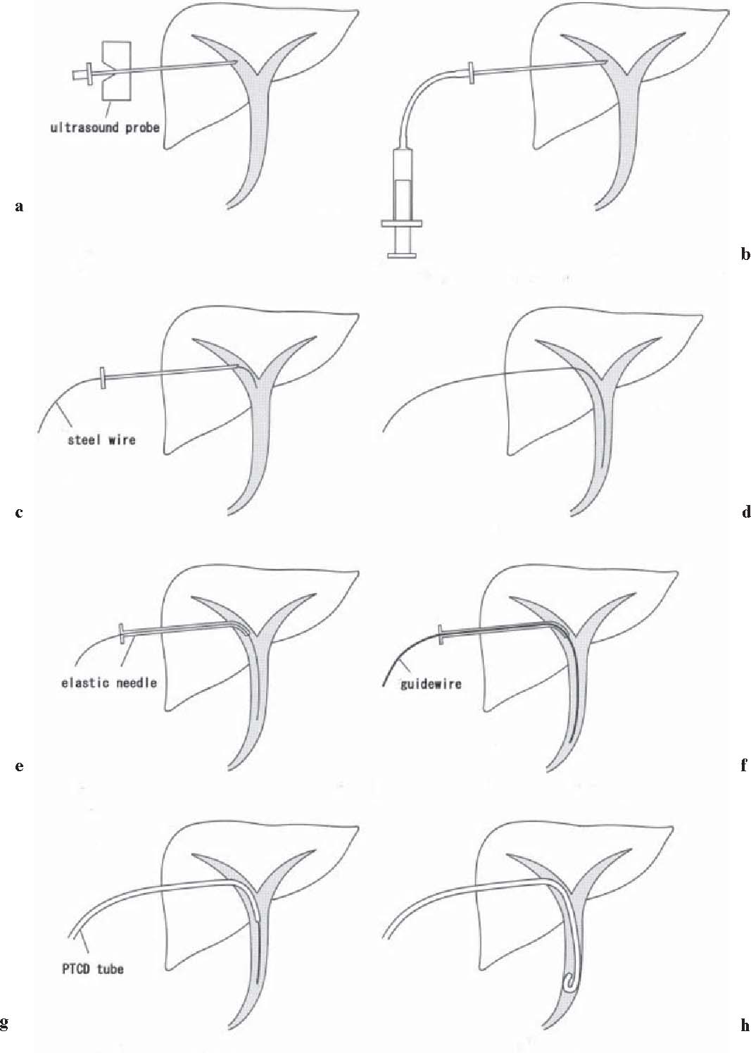 Techniques of biliary drainage for acute cholangitis: Tokyo Guidelines ...