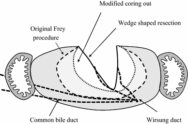 Assessment of Frey procedures: Japanese experience | SpringerLink