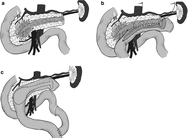 Assessment of Frey procedures: Japanese experience | SpringerLink