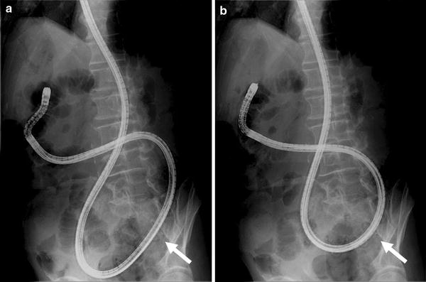 Spiral enteroscopy for therapeutic ERCP in patients with surgically ...
