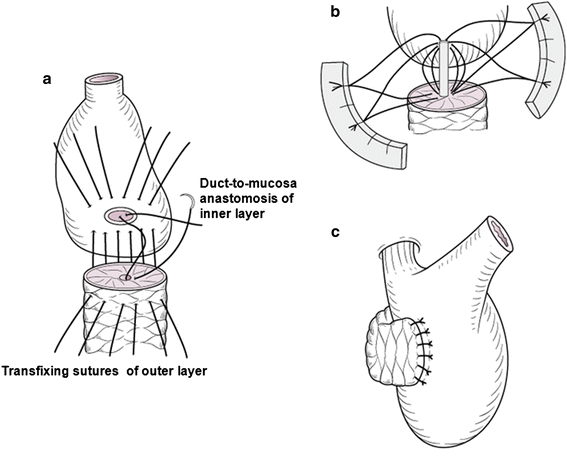 Pancreaticogastrostomy: a pancreas-transfixing method with duct-to ...