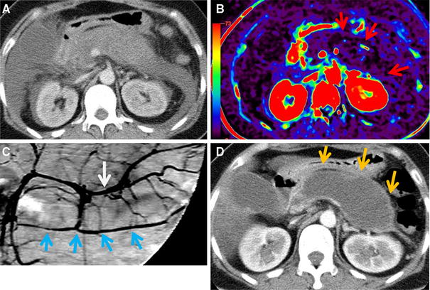 Perfusion CT is superior to angiography in predicting pancreatic ...