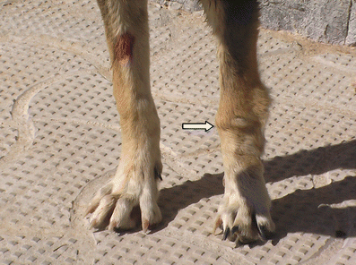 Unilateral premature closure of distal radial growth plate due to ...