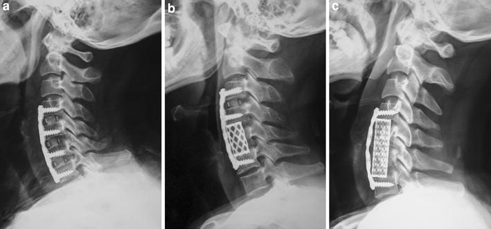 Outcomes of three anterior decompression and fusion techniques in the ...