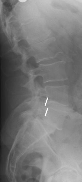 A slip above a slip: retrolisthesis of the motion segment above a ...