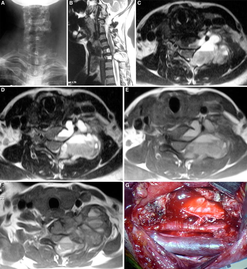 Aneurysmal bone cysts of the spine | SpringerLink
