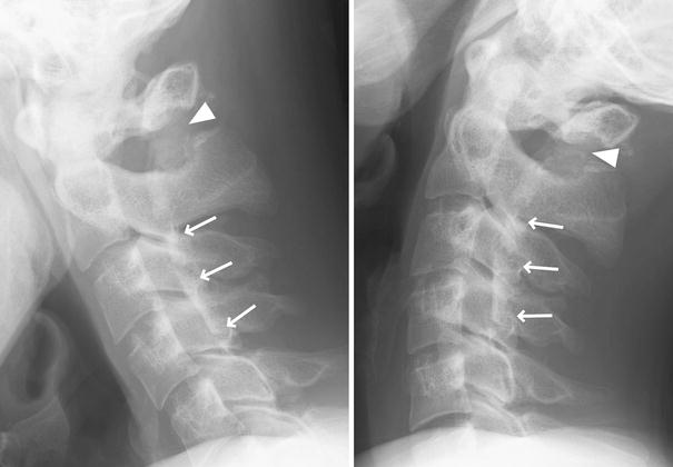 Multiple-level ossification of the ligamentum flavum in the cervical ...