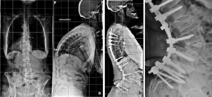 Classification of degenerative segment disease in adults with deformity ...