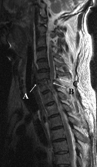 Dural tear and resultant cerebrospinal fluid leaks after cervical ...