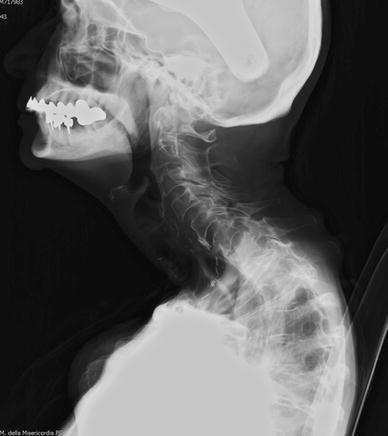 Pedicle subtraction osteotomy for the treatment of chin-on-chest ...