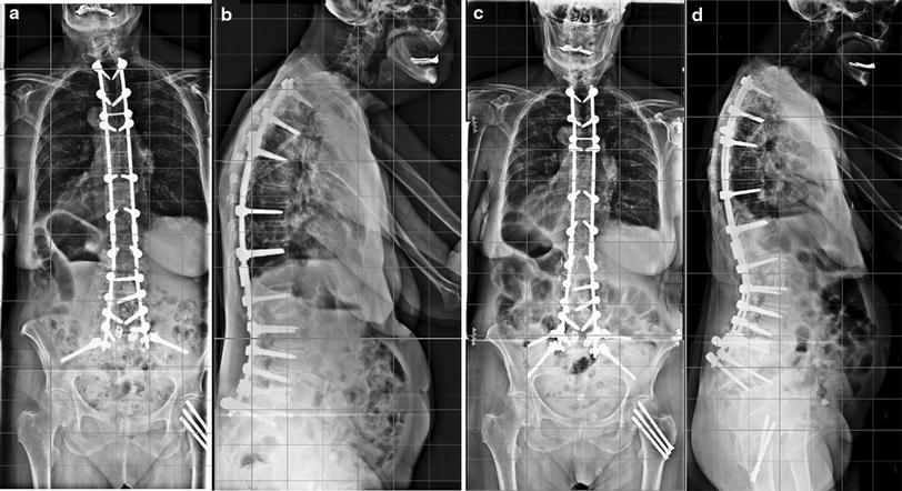 Pedicle subtraction osteotomies (PSO) in the lumbar spine for sagittal ...