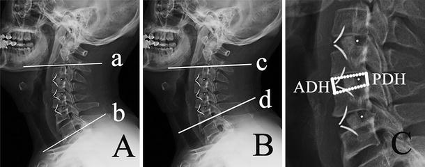A comparison of anterior cervical discectomy and fusion (ACDF) using ...