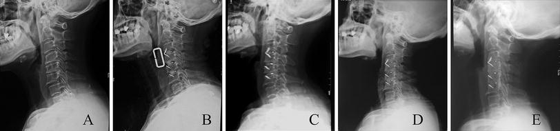 A comparison of anterior cervical discectomy and fusion (ACDF) using ...