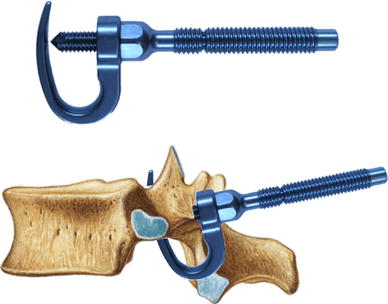 A pedicle screw system and a lamina hook system provide similar primary ...