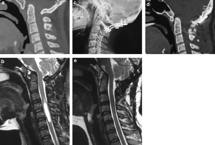 The changes of syrinx volume after posterior reduction and fixation of ...