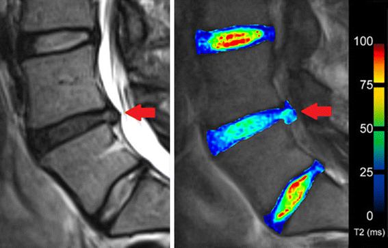 Does T2 mapping of the posterior annulus fibrosus indicate the presence ...
