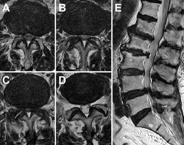 Low back pain due to middle cluneal nerve entrapment neuropathy ...