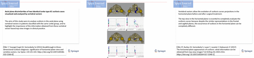 Axial plane dissimilarities of two identical Lenke-type 6C scoliosis ...