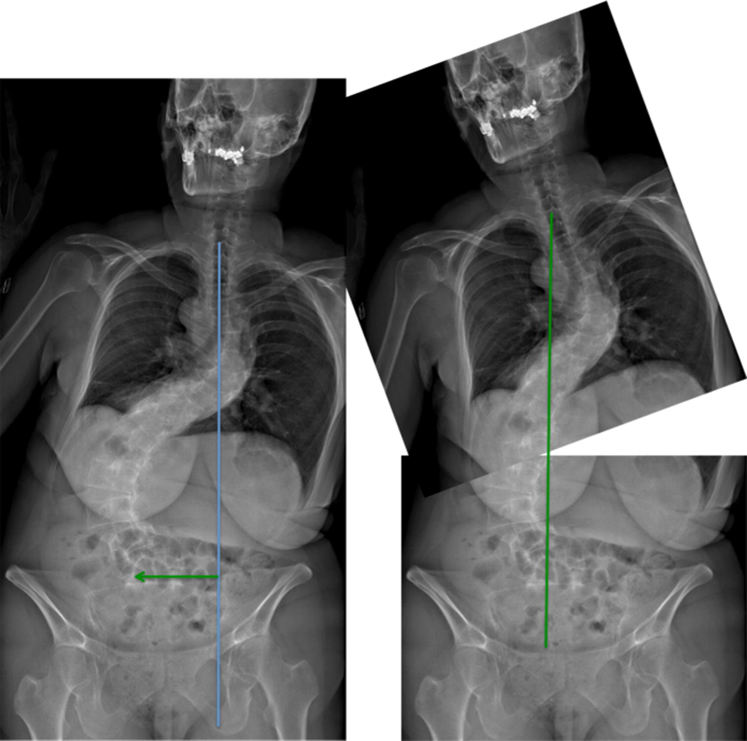 Classification of coronal imbalance in adult scoliosis and spine ...
