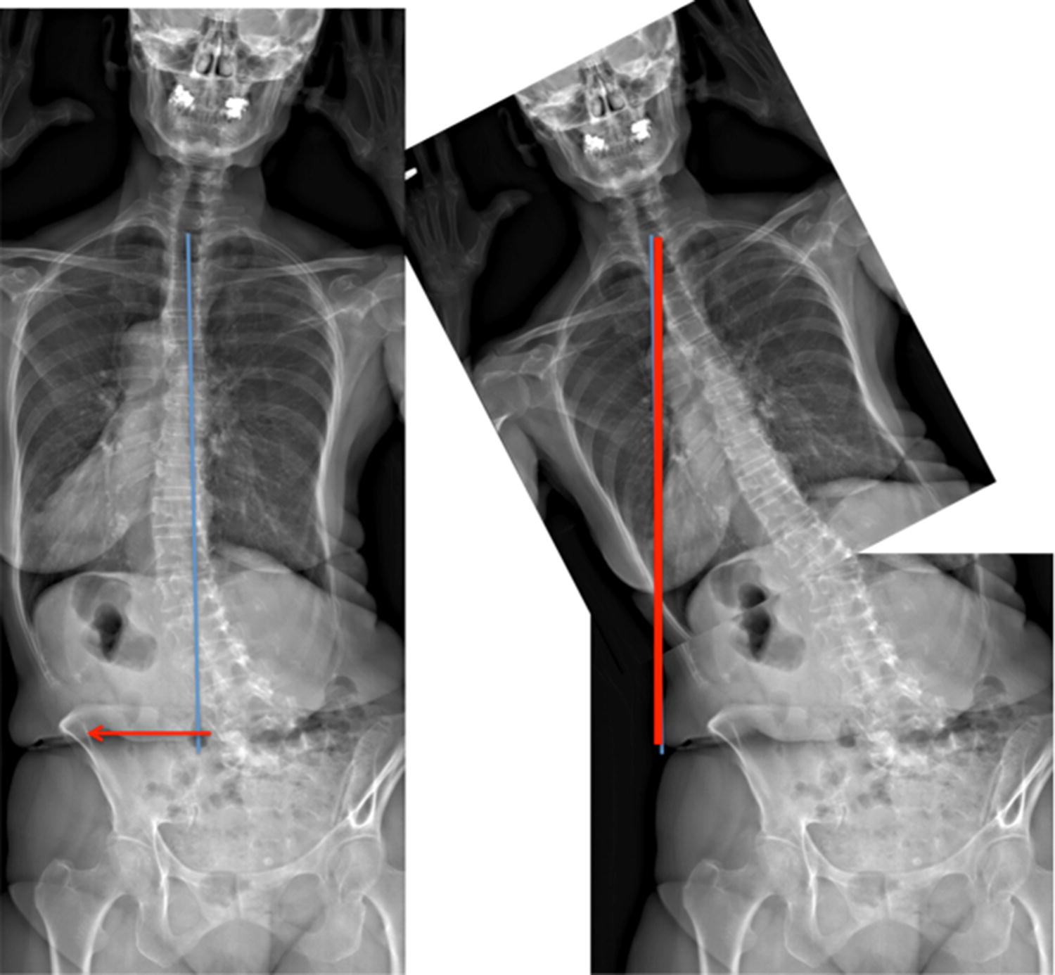 Classification of coronal imbalance in adult scoliosis and spine ...
