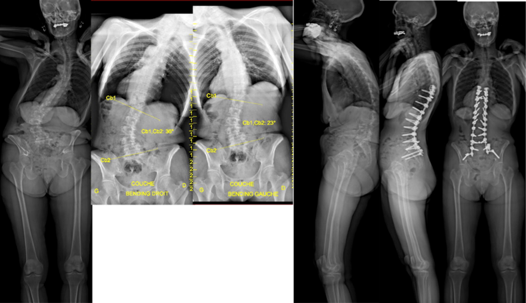 Classification of coronal imbalance in adult scoliosis and spine ...
