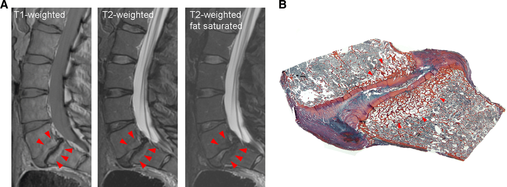 Measuring and reporting of vertebral endplate bone marrow lesions as ...